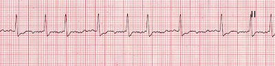 Atrial Fibrillation and Atrial Flutter