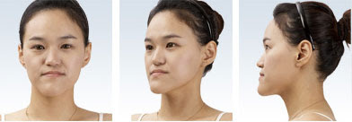 ID Hospital Korea: mandible prognathism surgery experiences