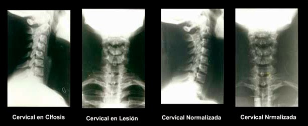 MEDICINA: CERVICALGIA Y CERVICOBRAQUIALGIA