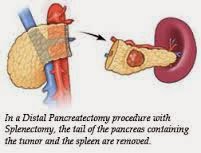 OTMANAGE: Distal Pancreatectomy