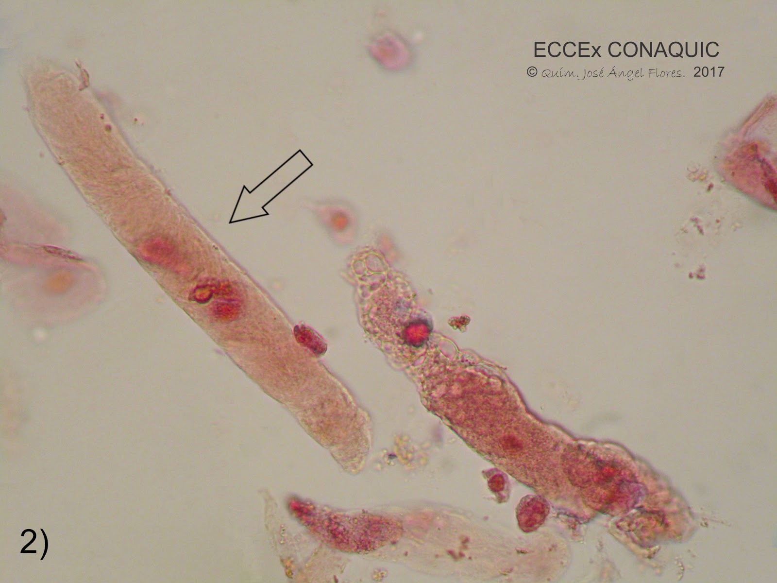 Caso UR-diciembre-17 (Enfoque: cilindruria)