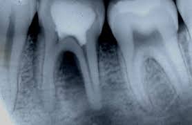 DúvidasOdonto: Classificação das Lesões de Furca