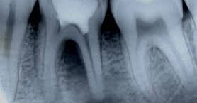 DúvidasOdonto: Classificação das Lesões de Furca
