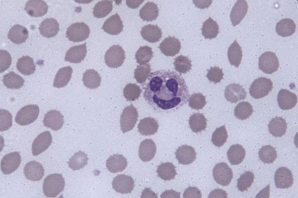 Medical Laboratory and Biomedical Science: A Smiling Neutrophil