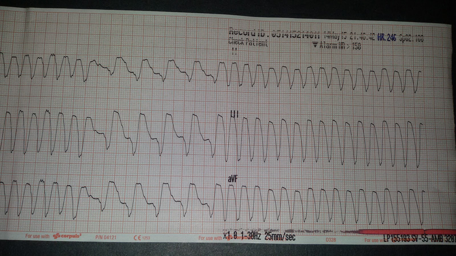 Infarct miocardic subacut și tahicardie ventriculara