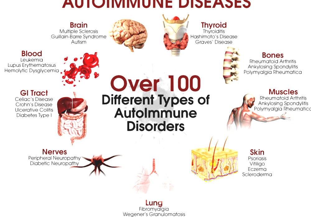Autoimmune Disease - Best Autoimmune Doctors