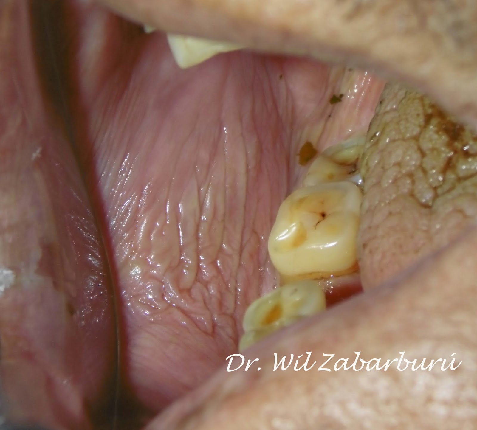 Leucoedema