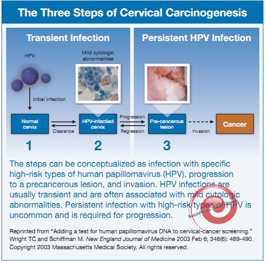 Genital HPV Infections ~ Happy life with cp