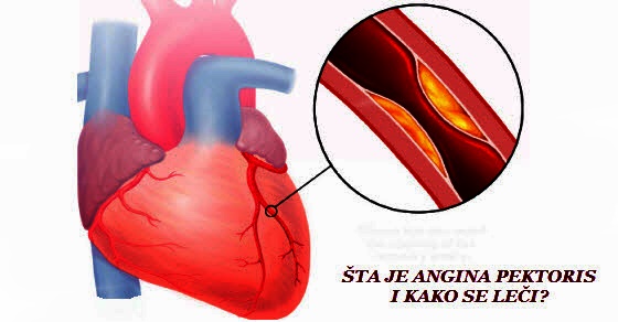 SIBIRSKO ZDRAVLJE: *** ANGINA PEKTORIS