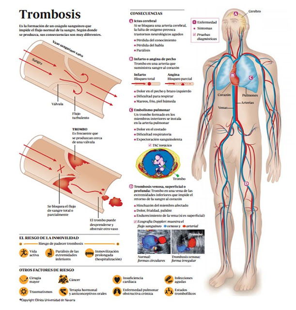 SALUD CON SENTIDOS: Trombosis, una enfermedad común y peligrosa.
