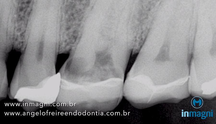 ENDODONTIA: Reabsorção cervical - reconstrução cervical e coronária ...