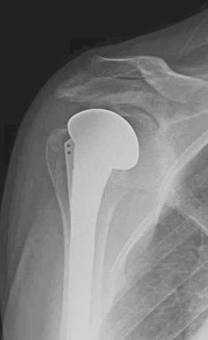 Shoulder Arthritis / Joint Replacement : A difficult combination ...