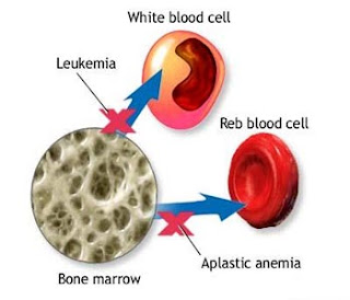 Overview of the hemolytic anemia | Healthy Heart