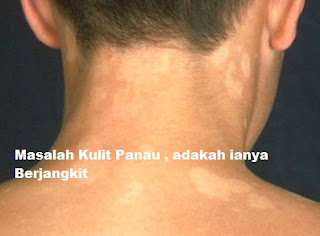 Cara hilangkan Panau cepat ~ akufisio.blogspot