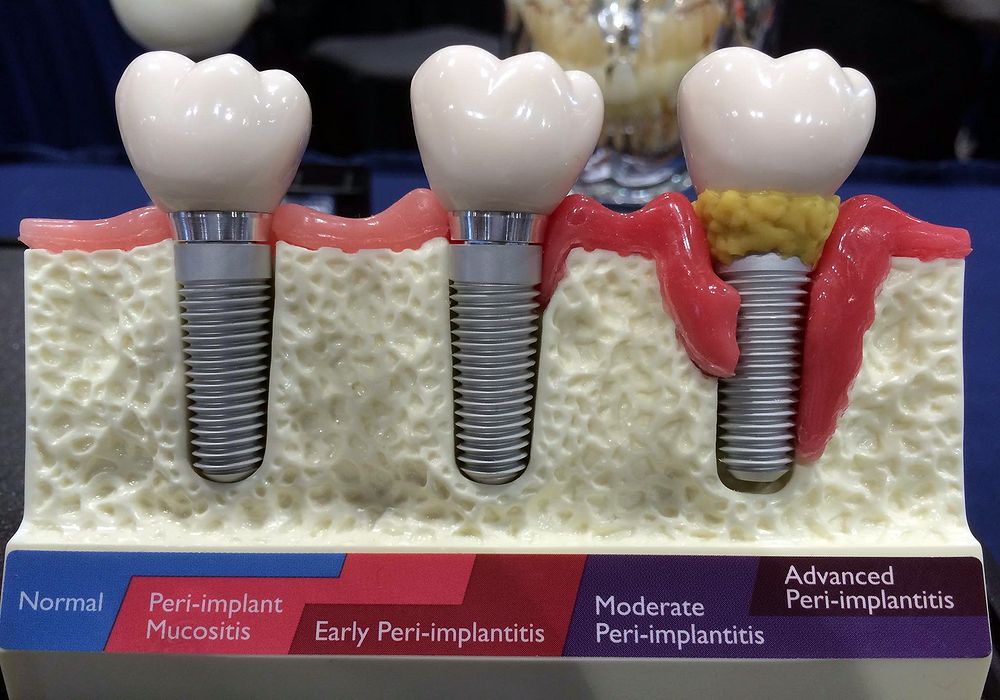 What is Peri implantitis? | Directorio Odontológico