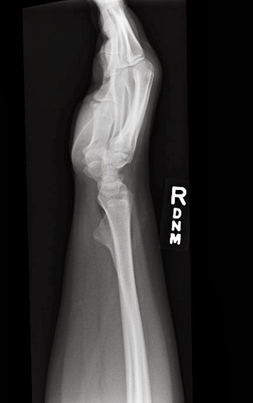 Bony Outgrowth, osteochondroma | Congenital Hand and Arm Differences ...