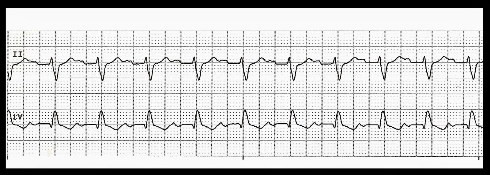 Various First Degree Heart Blocks