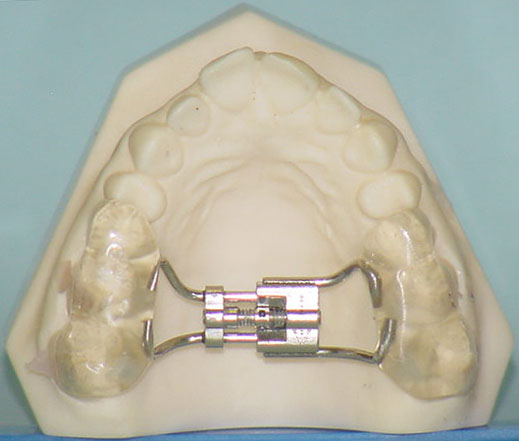 James R. Waters, DDS, MSD, PA: What to expect after a bonded Expander ...