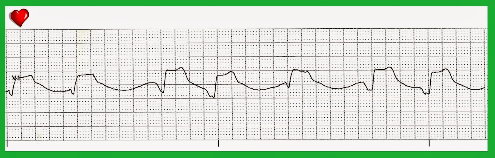 Practice EKG Strips 429