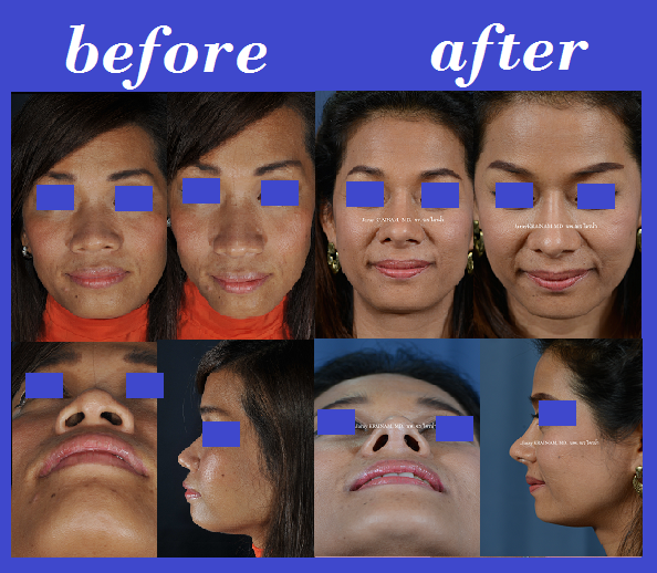 Bangkok Aesthetic Surgery Center: Looking for Permanent And Lifetime ...