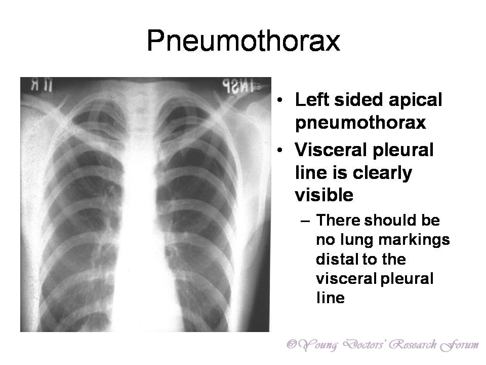 Identification of Chest X-rays of Common Lung Diseases ~ YOUNG DOCTORS ...