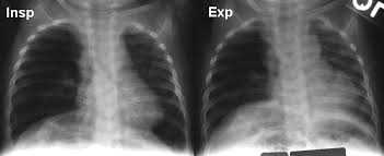 What To Do When The Nurse Calls YOU !: How to Read Chest X- Ray
