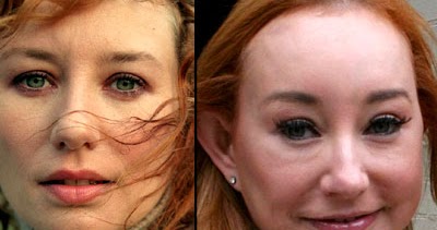 Aestheticdoctor: The Overfilled Syndrome Caused by Too Much Injectable ...