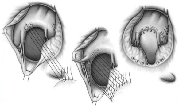 MEDI LEARNER: VENTRICULAR SEPTAL DEFECT (VSD)