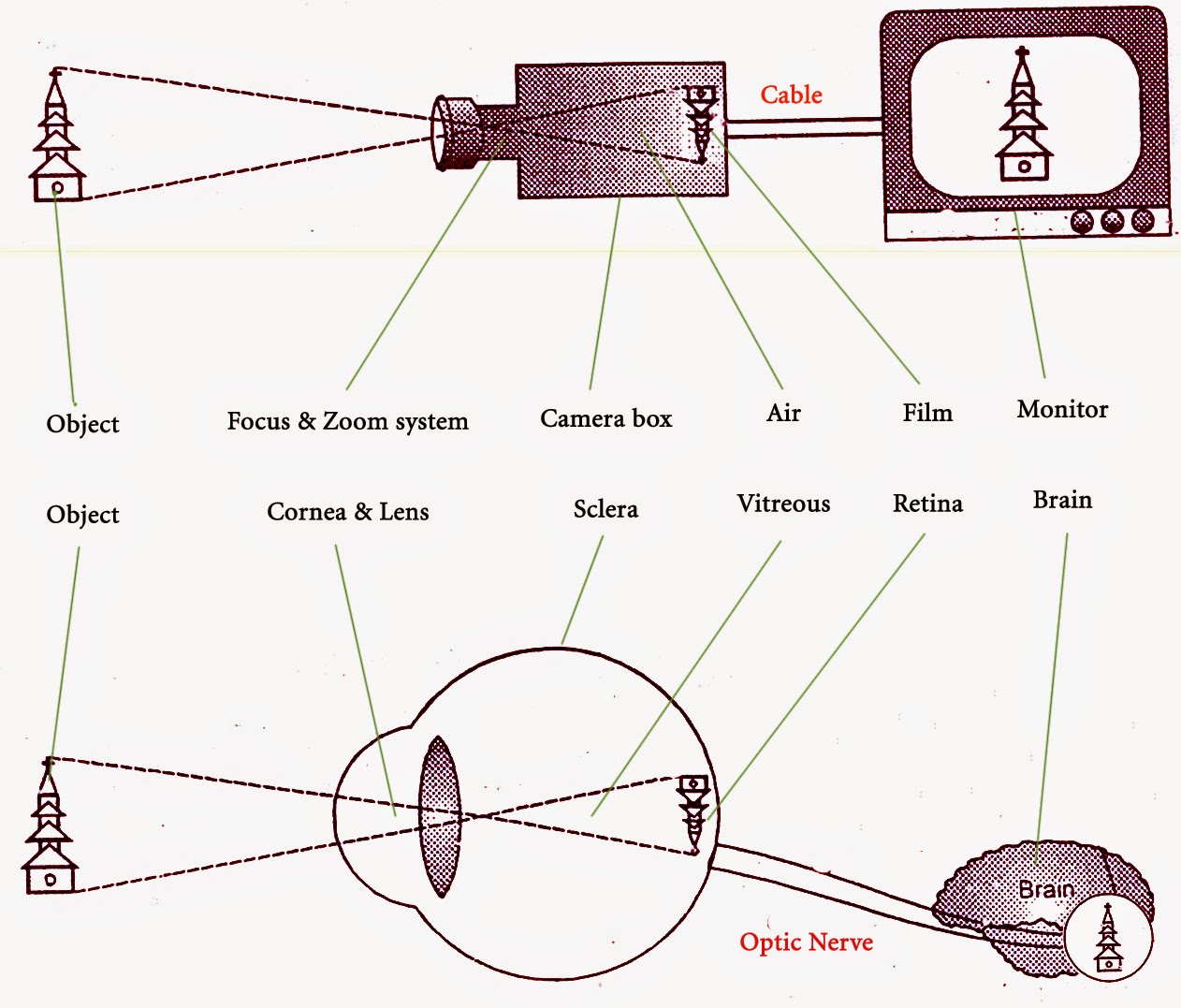 Myopia,Retinal Breaks,Retinal Detachment