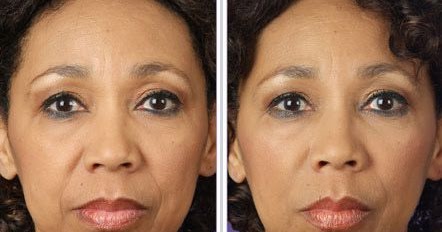 How To Use Facial Yoga To Get Rid Of Smile Lines And Mouth Wrinkles ...