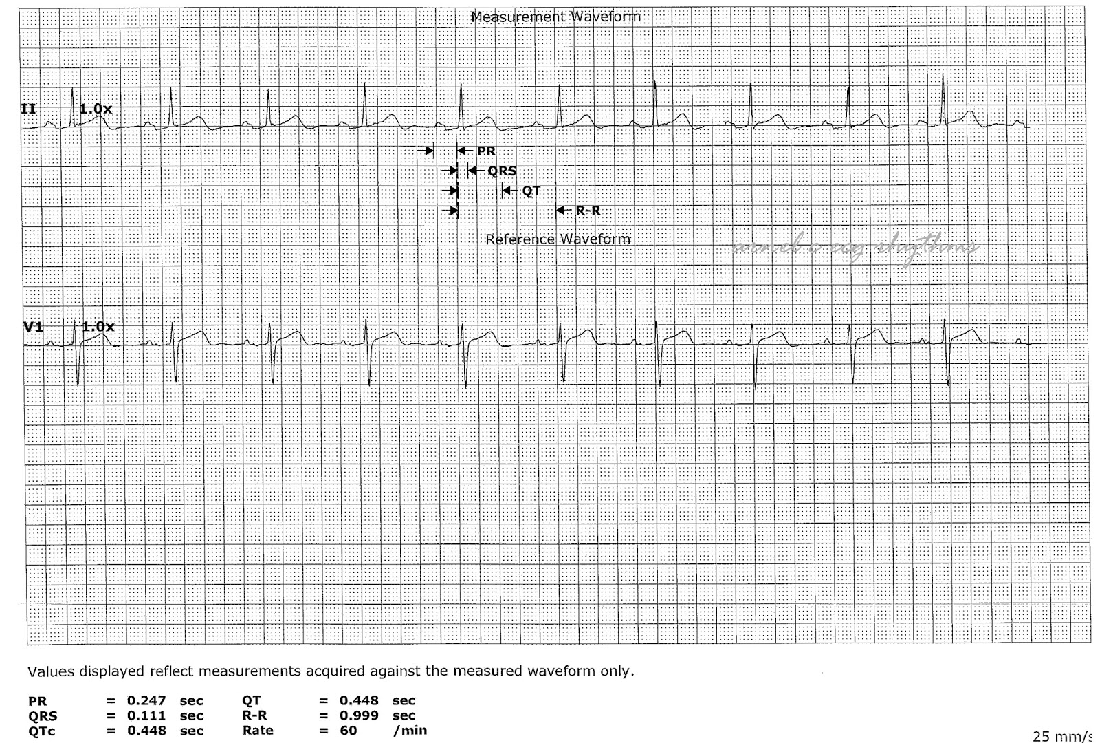 ECG Rhythms: Measurement Practice