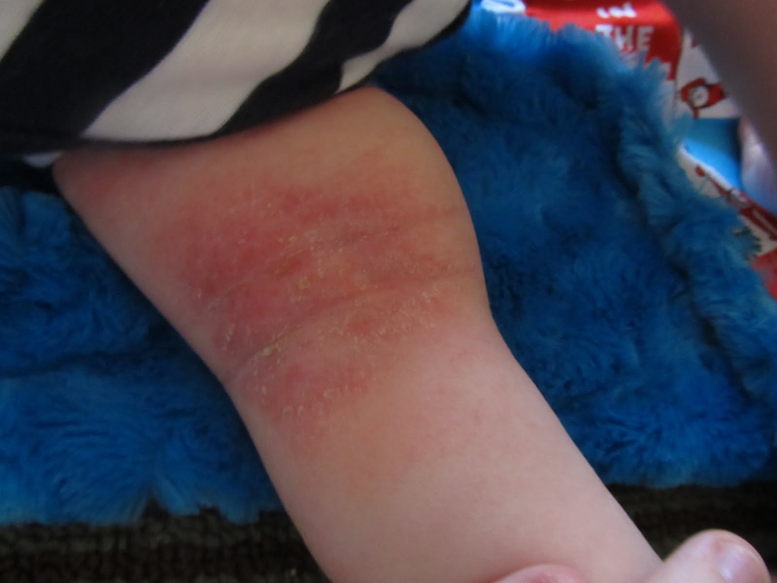 Triplets + Toddler: Eczema