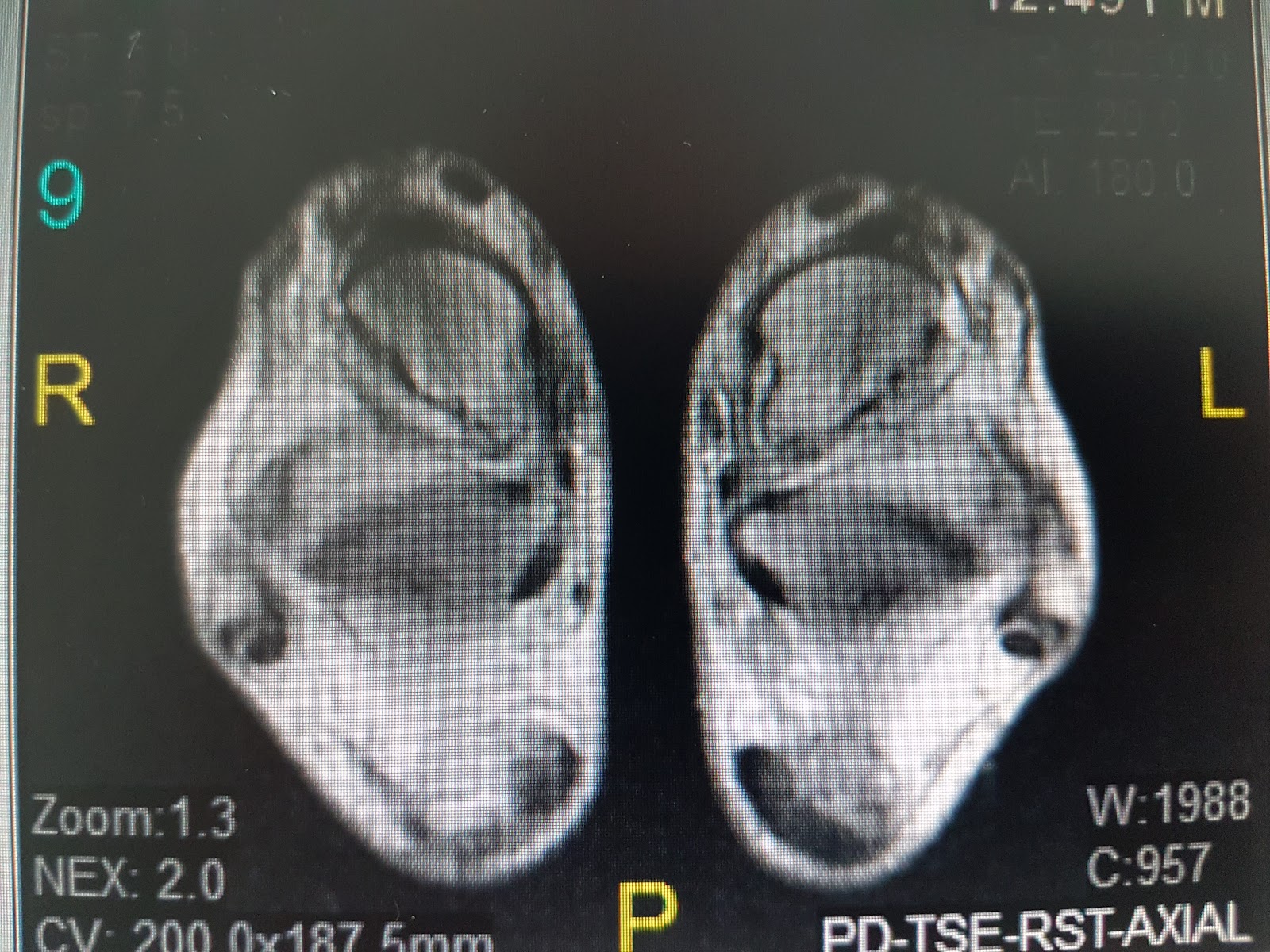 Podo Basas al Día: Fascitis plantar con Topaz. Espolón calcáneo. Rotura ...