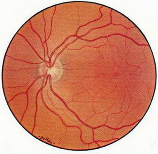 Oklusi Arteri Retina Sentralis, Central Retinal Artery Occlusion (CRAO ...