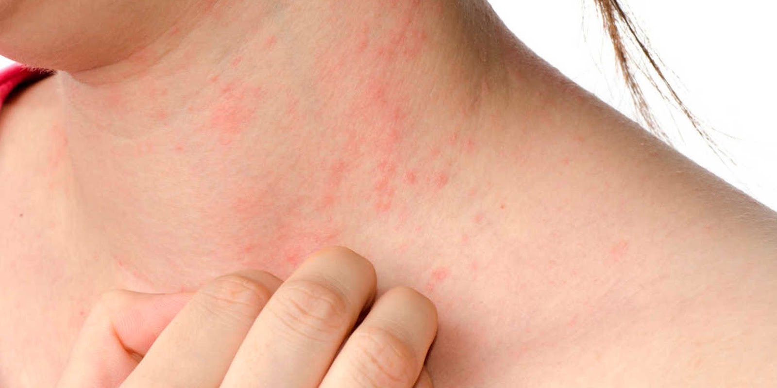 Primeros Auxilios : Estado de Shock Anafilactico