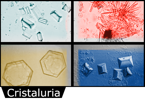 el Hallazgo: Cristaluria y uroanálisis