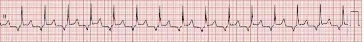 EKG Rhythm Strips 29: Junctional Rhythms