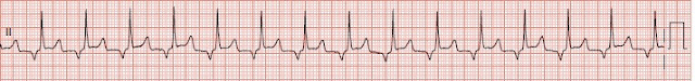 EKG Rhythm Strips 29: Junctional Rhythms