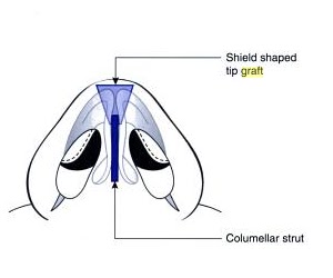 Nose Revision Surgery and Surgeons: The mystery of all the different ...