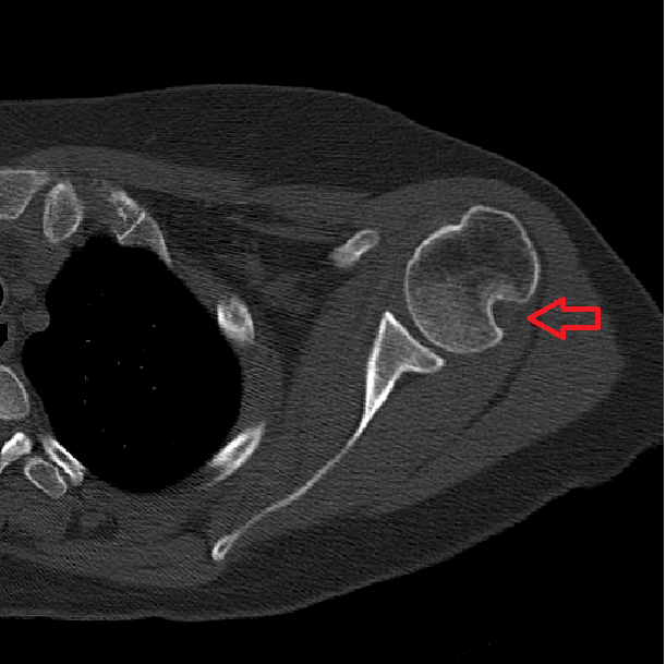 Shoulder and Elbow Surgery: The patient with the 30 shoulder ...