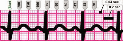 ECG Rates and Measurements ~ Nursing