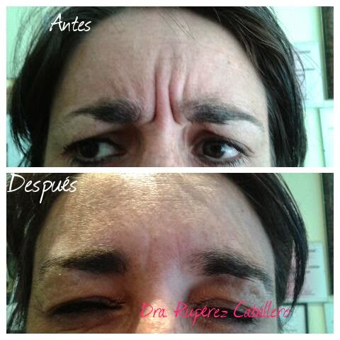 Medicina Estética Dra. Elena Rupérez Caballero: Tratamiento con Botox ...