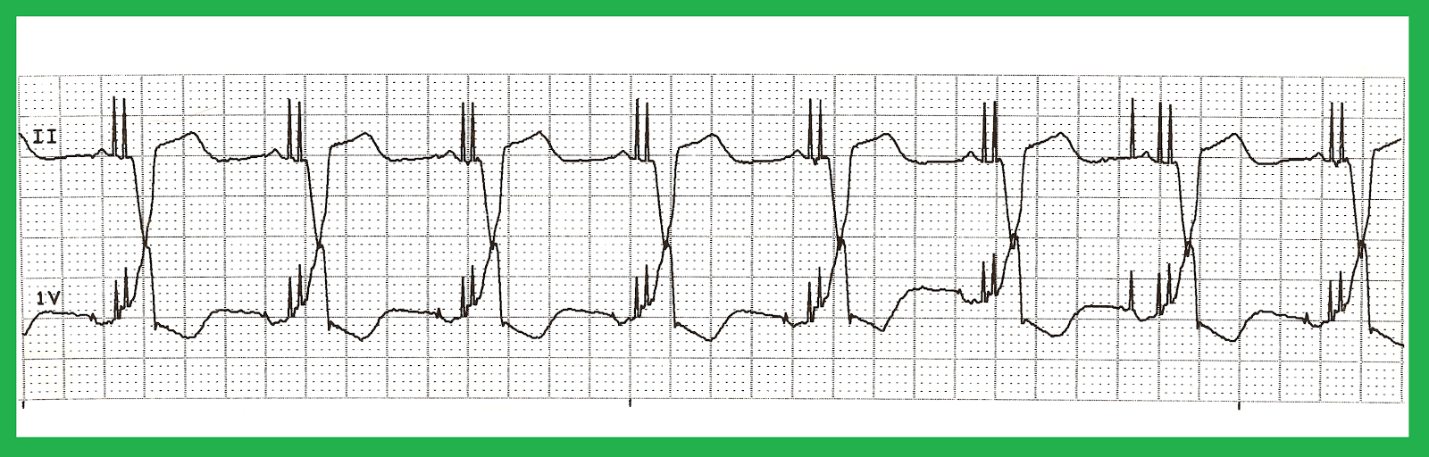 Practice EKG Strips 334