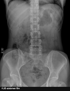 Adventures in Radiation: A normal abdominal xray