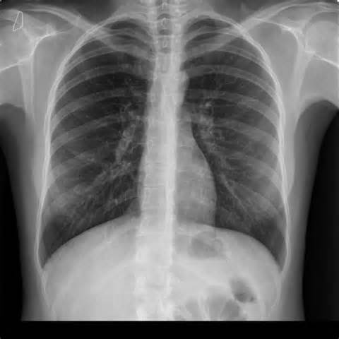 DICA - RX DE TÓRAX - Radiologia e Concursos