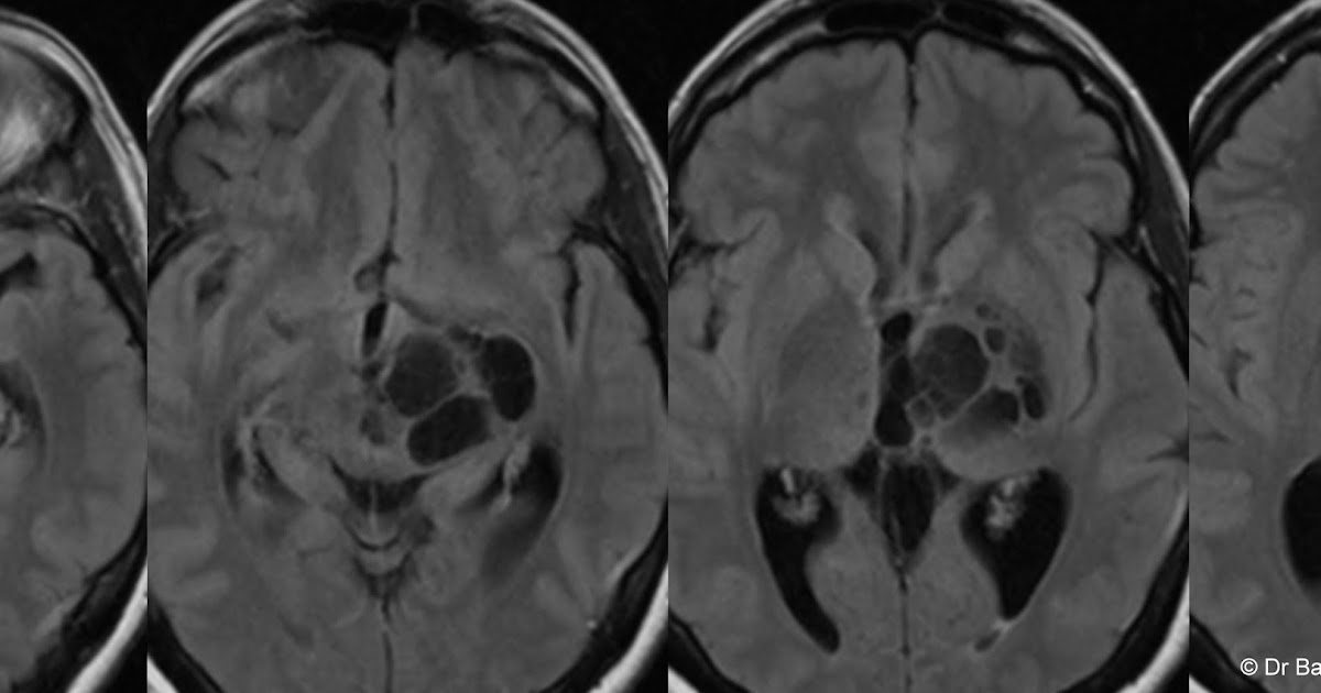 Dr Balaji Anvekar FRCR: Giant Tumefactive Perivascular Spaces MRI
