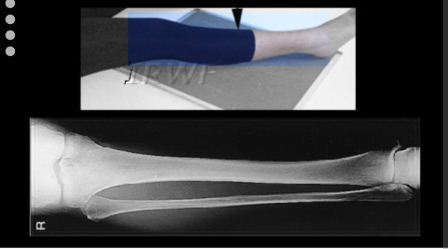 Femur e Perna- AP Perna