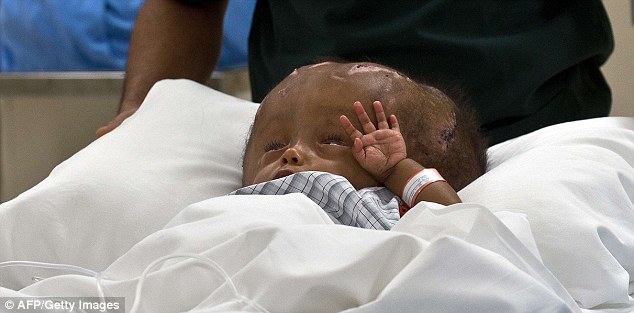NasBank Blog: Baby With Swollen Head Undergoes Third Successful Operation