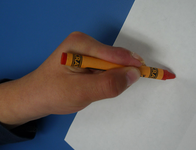 Symbrachydactyly | Congenital Hand and Arm Differences | Washington ...