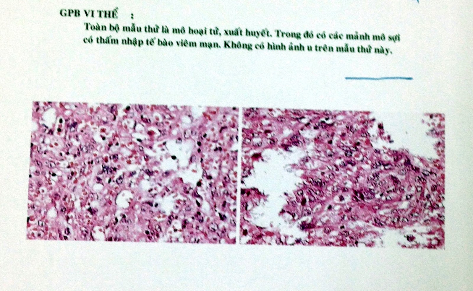 VIETNAMESE MEDIC ULTRASOUND: CASE 407: LIVER INFARCTION, Dr PHAN THANH ...